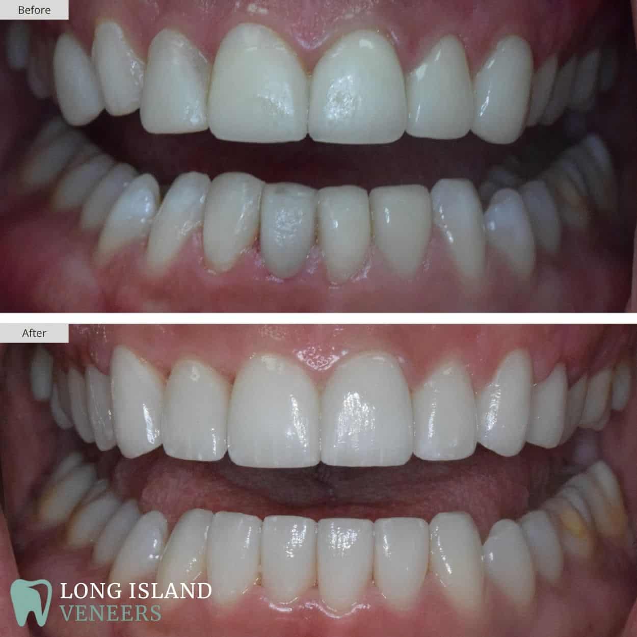 Dental Veneers Before & After Photos in Long Island, NY
