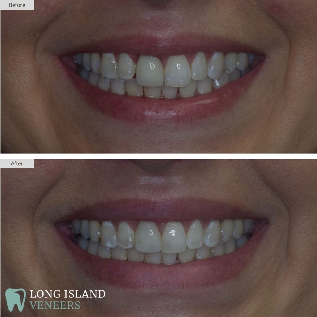 Dental Veneers Before & After Photos in Long Island, NY