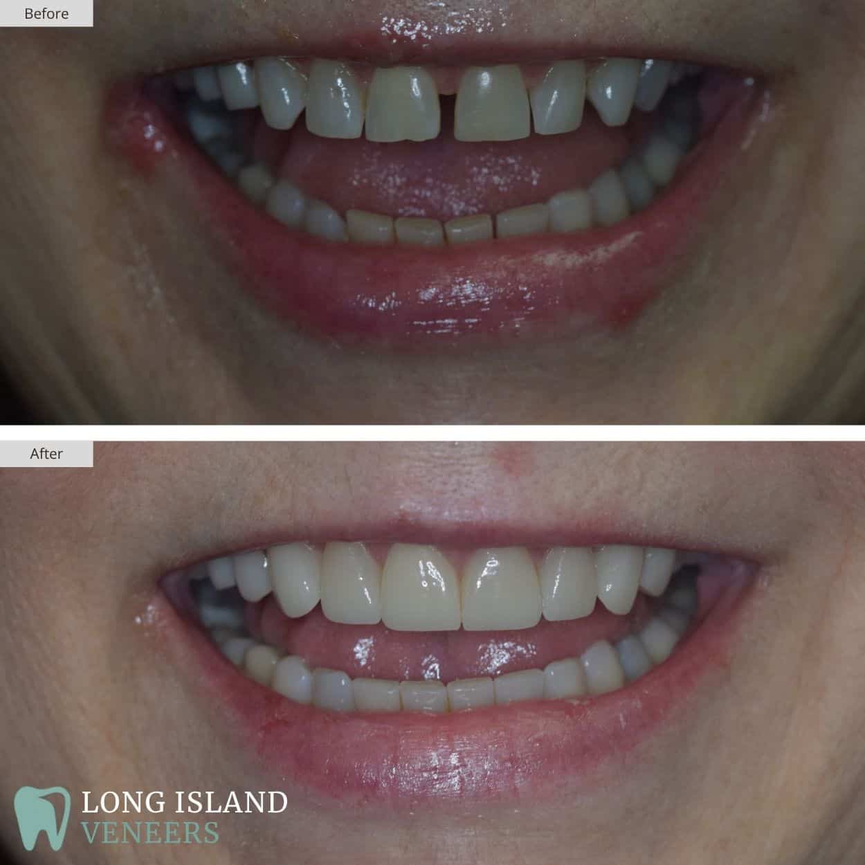 Dental Veneers Before & After Photos in Long Island, NY